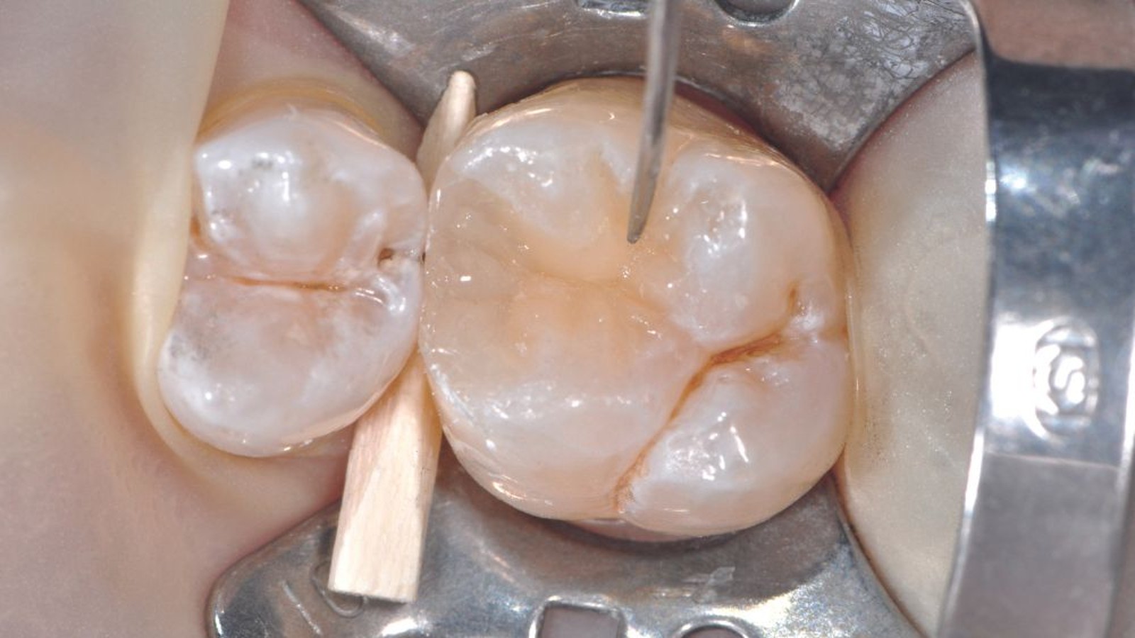 Comprendre l’importance du scellement de sillons pour la préventi
