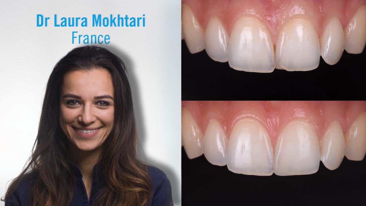 Transformer les sourires avec Kulzer